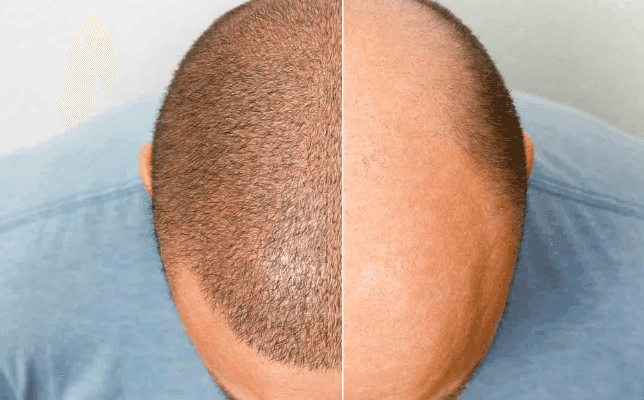 Hair Plugs in Mexico